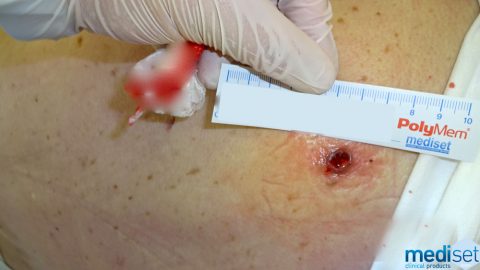 Serom - Definition, Entstehung und Behandlung | Mediset